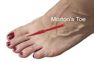 Mortons Toe | Local News | trinidadexpress.com