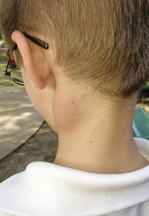 Yikes: Oak tree mites bring chigger-like bite outbreak from above ...