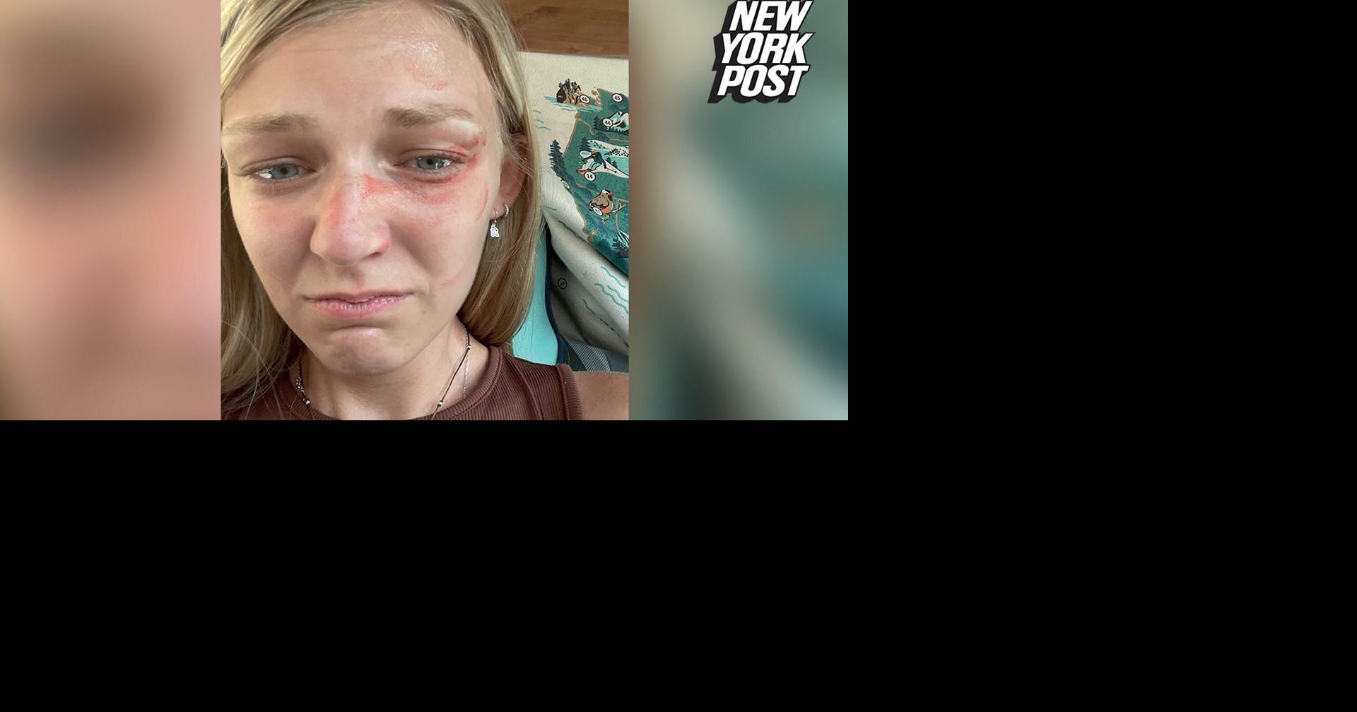 Newly revealed Gabby Petito pic shows her bruised just weeks before she ...