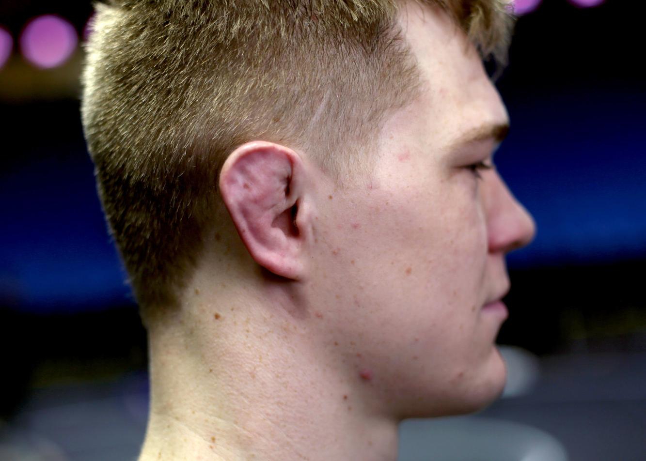 They all have them. One called it 'a badge of honor.' Some striking ...