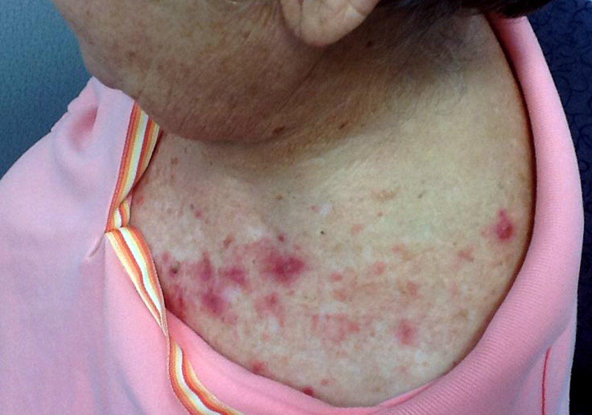 Creepy crawlies on the breeze: Oak leaf itch mites are at it again ...