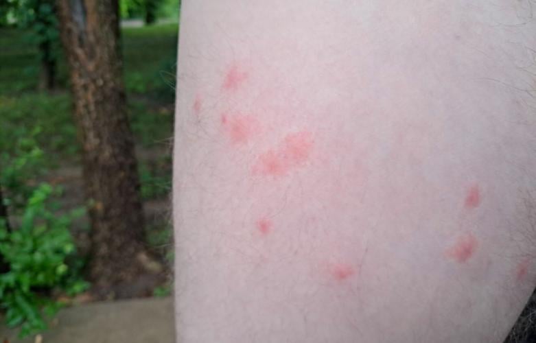 chigger bites florida