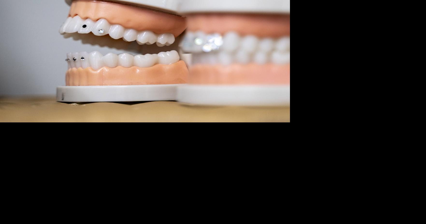 Tooth gem trend: Adhering gems and crystals to teeth has become a ...