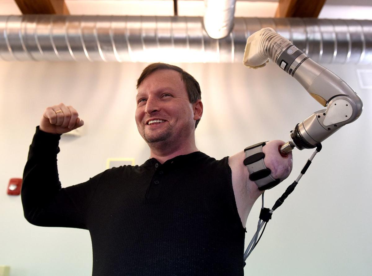 Luke arm and special surgery gives amputees better movement | Science ...
