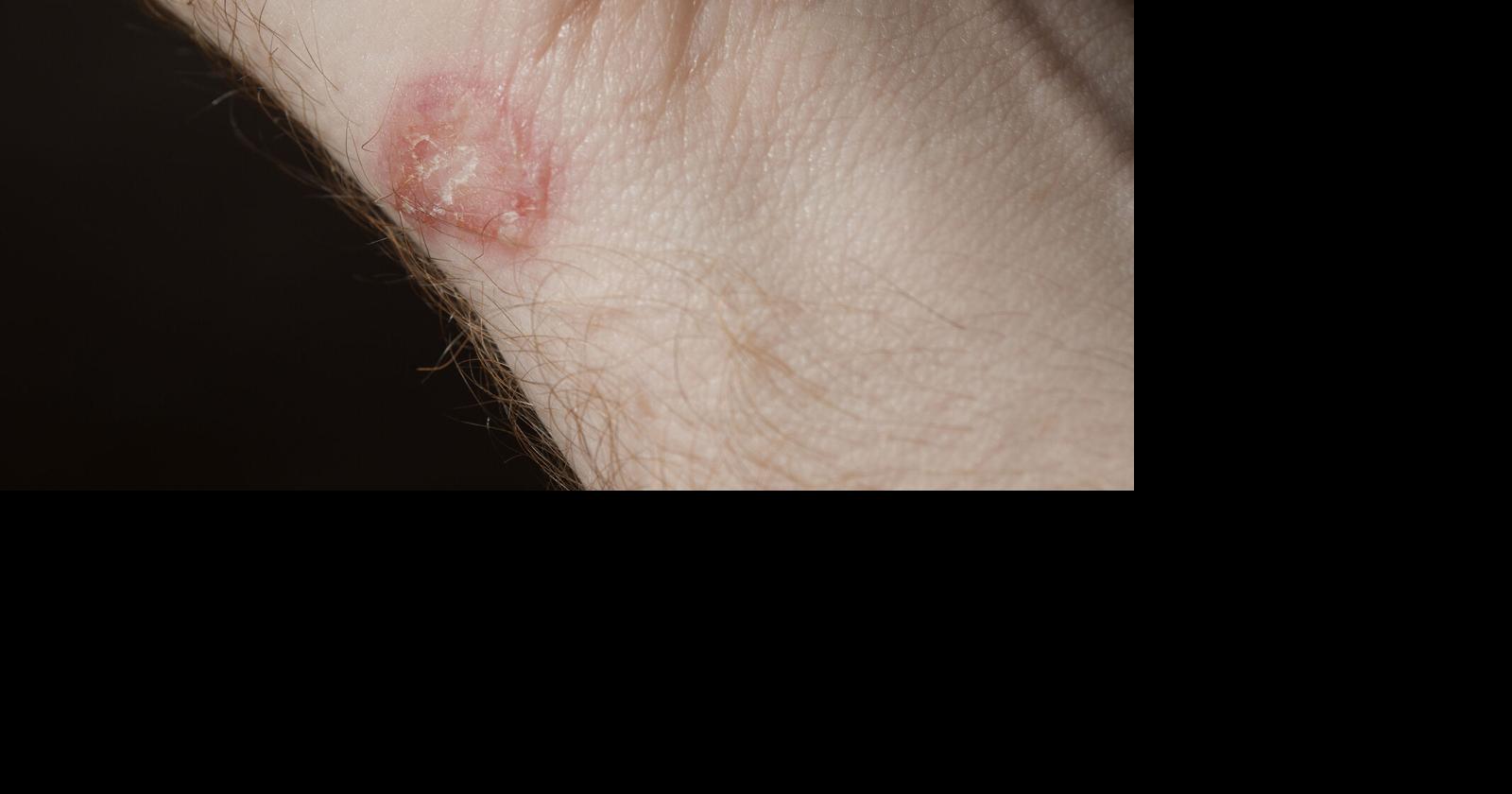 US has first case of sexually transmitted ringworm | Health ...