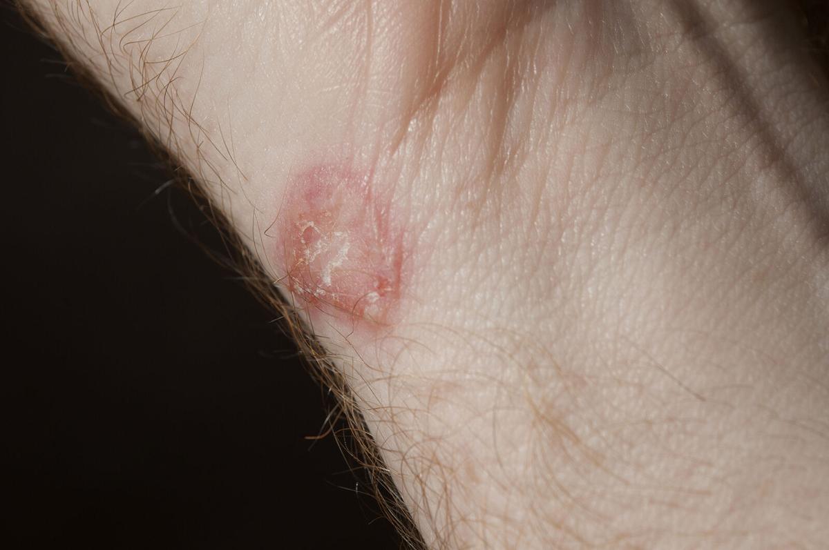 US has first case of sexually transmitted ringworm | Health ...