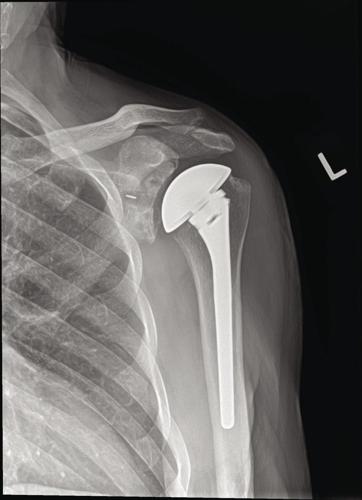 Sunday News Medical Journal: Reverse shoulder replacement - restoring ...