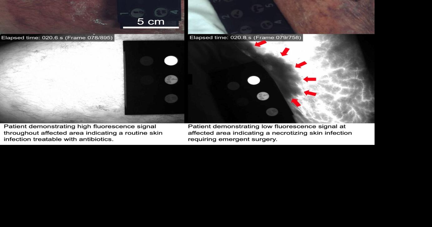 Diagnosing flesh-eating bacteria by injecting fluorescent dye ...