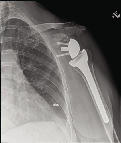 Sunday News Medical Journal: Reverse shoulder replacement - restoring ...
