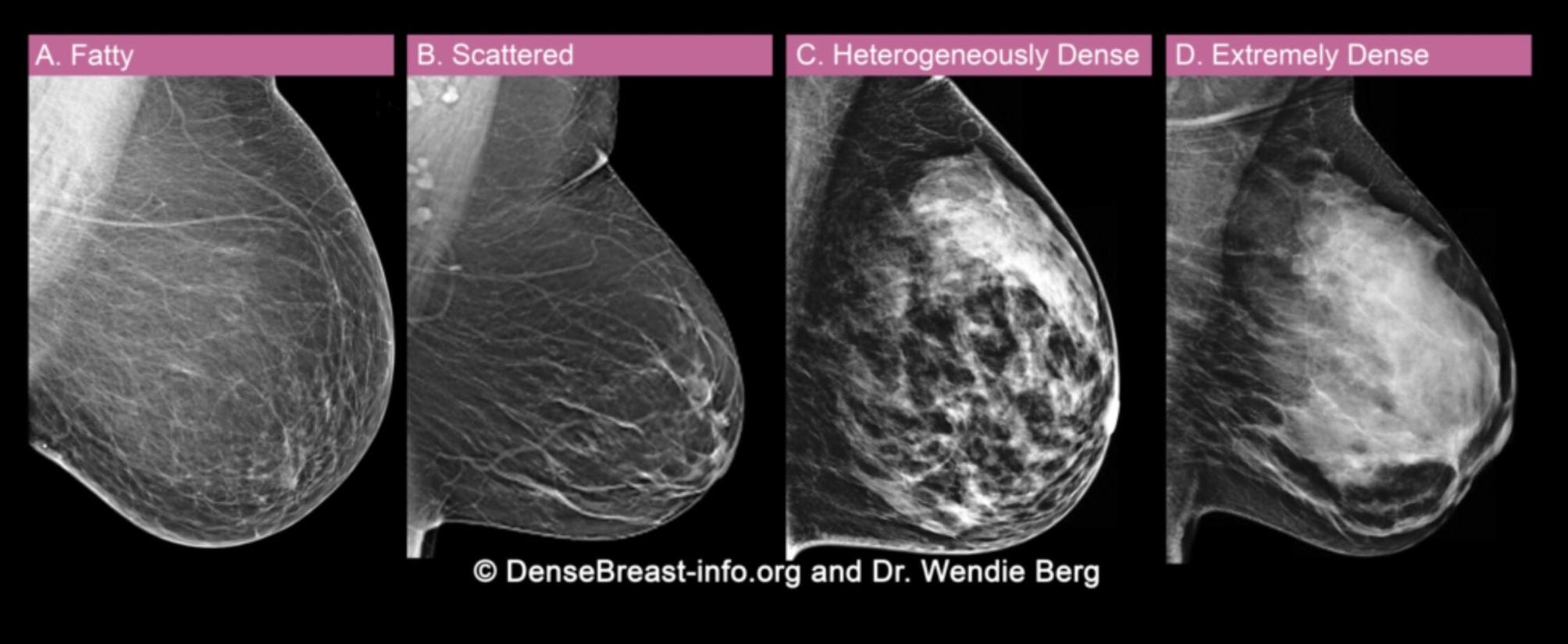 A podcaster’s story leads to diagnosis of Fremont woman’s hard-to-find ...