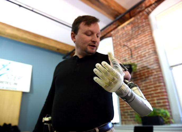 Luke arm and special surgery gives amputees better movement | Science ...