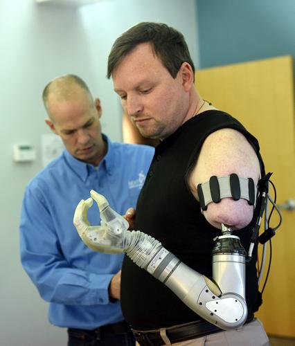 Luke arm and special surgery gives amputees better movement | Science ...