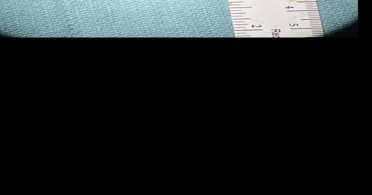 This man can see again, thanks to a tooth implanted in his eye | News ...