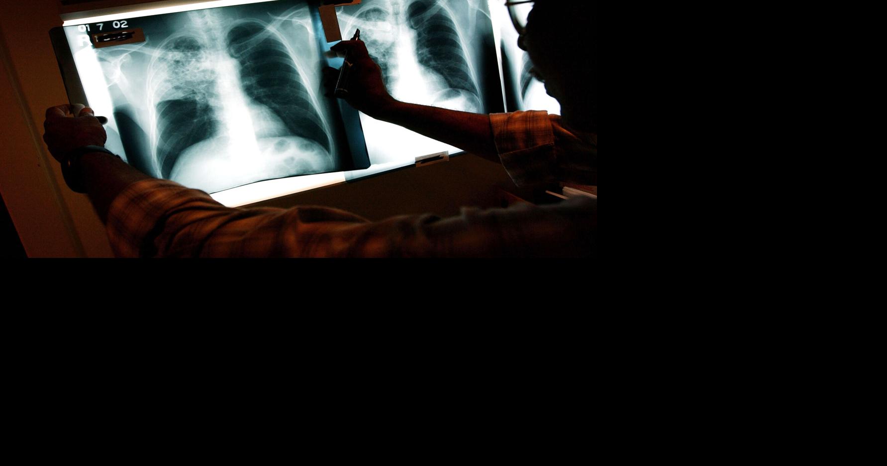 US tuberculosis cases nearing pre-pandemic levels, CDC data shows | News | waaytv.com