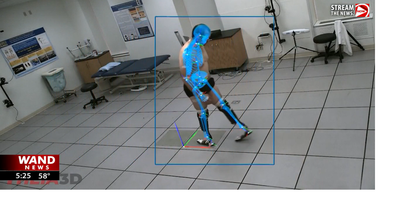 Amputee using prosthetic legs backwards now being studied | Videos ...