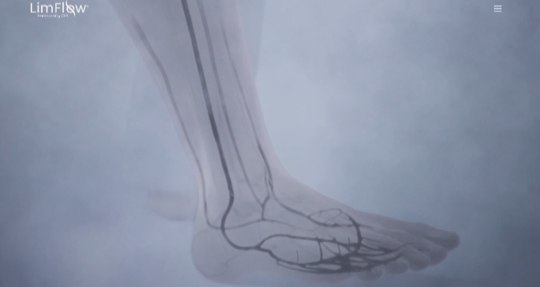 LimFlow gives possible amputees a second option | Top Stories | waow.com