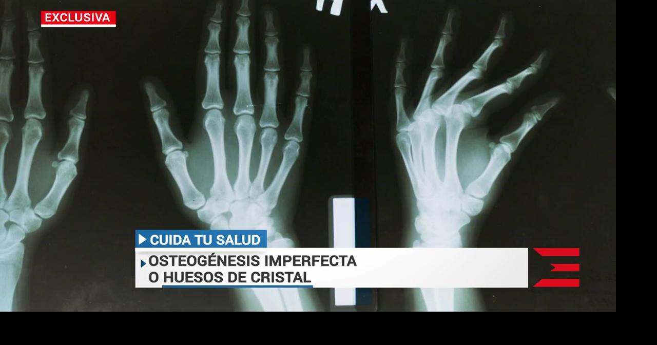 Cuida tu salud: ¿Qué es la osteogénesis imperfecta? | Salud | wapa.tv