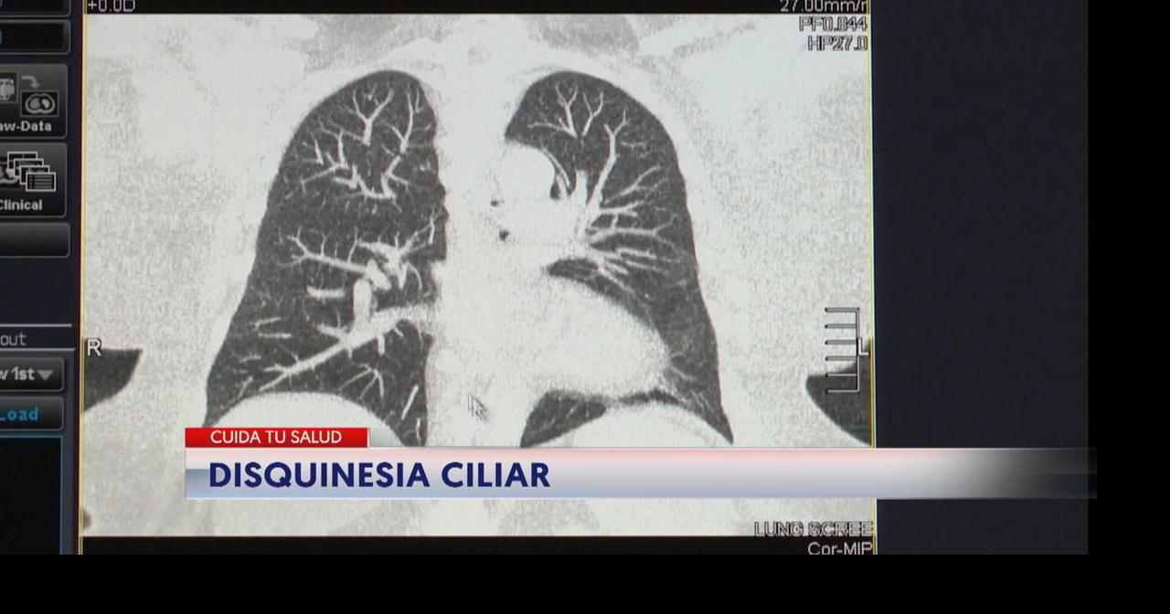 ¿Qué es la enfermedad de disquinesia ciliar? | Salud | wapa.tv