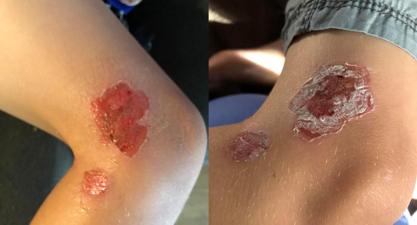 flesh eating condition