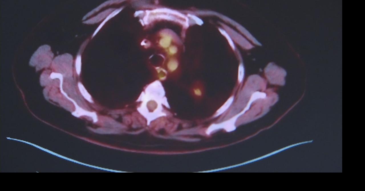 New treatment changes prognosis of Kentucky's biggest cancer killer ...