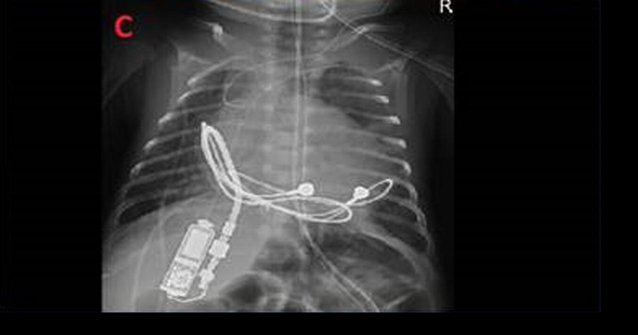 MEDICAL FIRST | Louisville doctors implant tiny pacemaker in 28-week ...