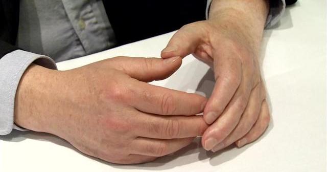 Man becomes emotional when recalling hand transplant 15 years ago ...