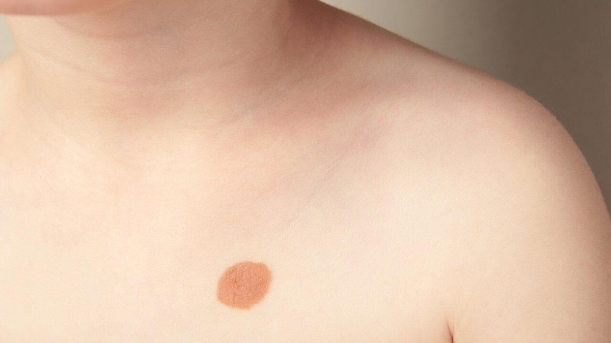 Moles vs. birthmarks: What's normal and what warrants a check | Health ...