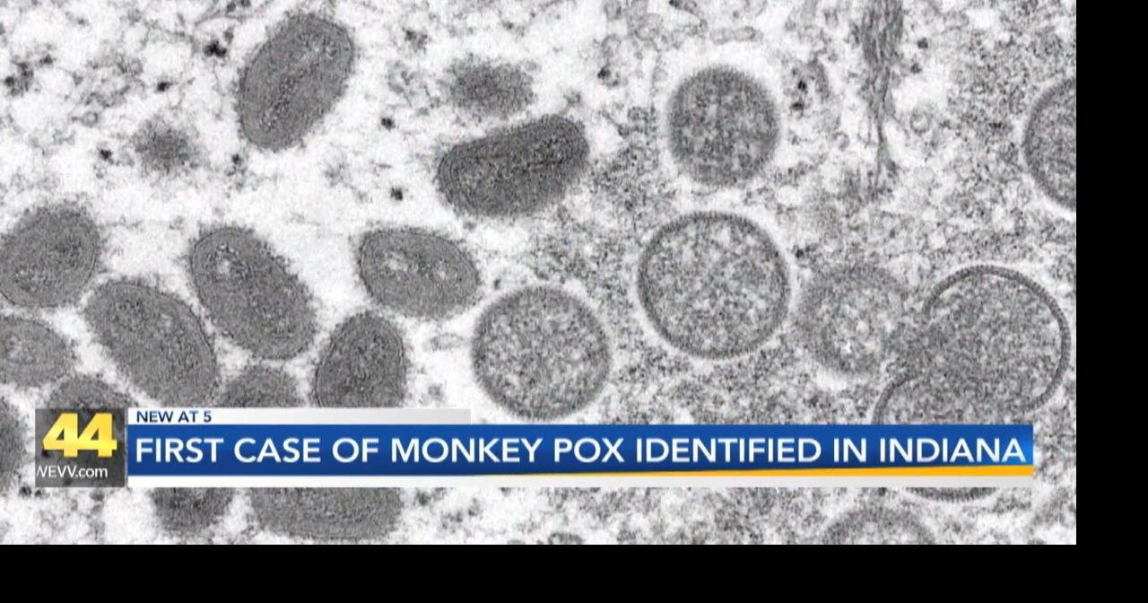 Deaconess doctor breaks down monkeypox after first case is detected in ...