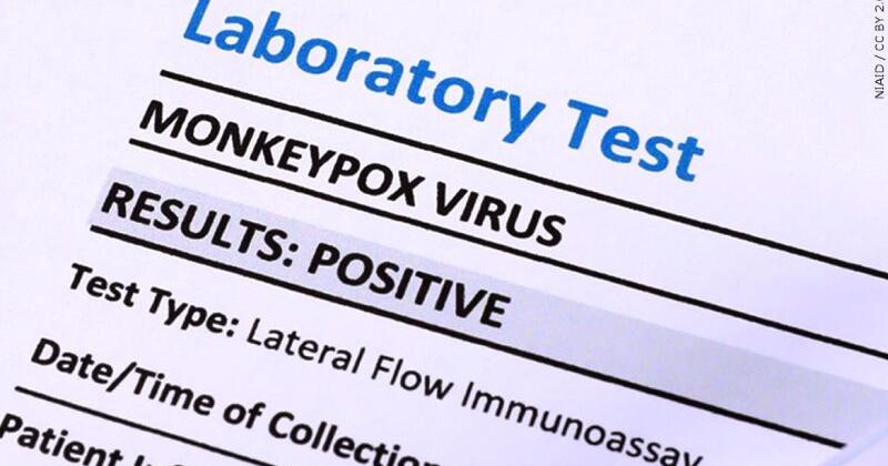 Indiana health officials tracking monkeypox cases in new online ...