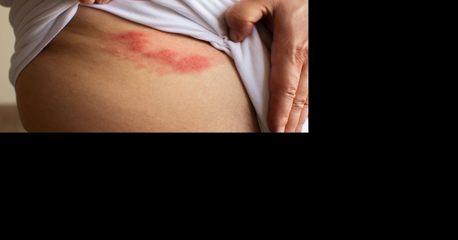 mild shingles armpit