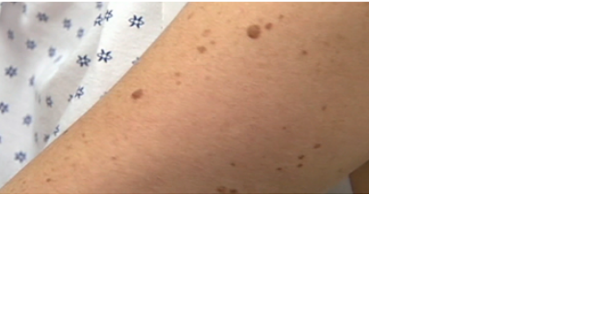 Health Beat: Skin cancer warning signs | | wfmz.com