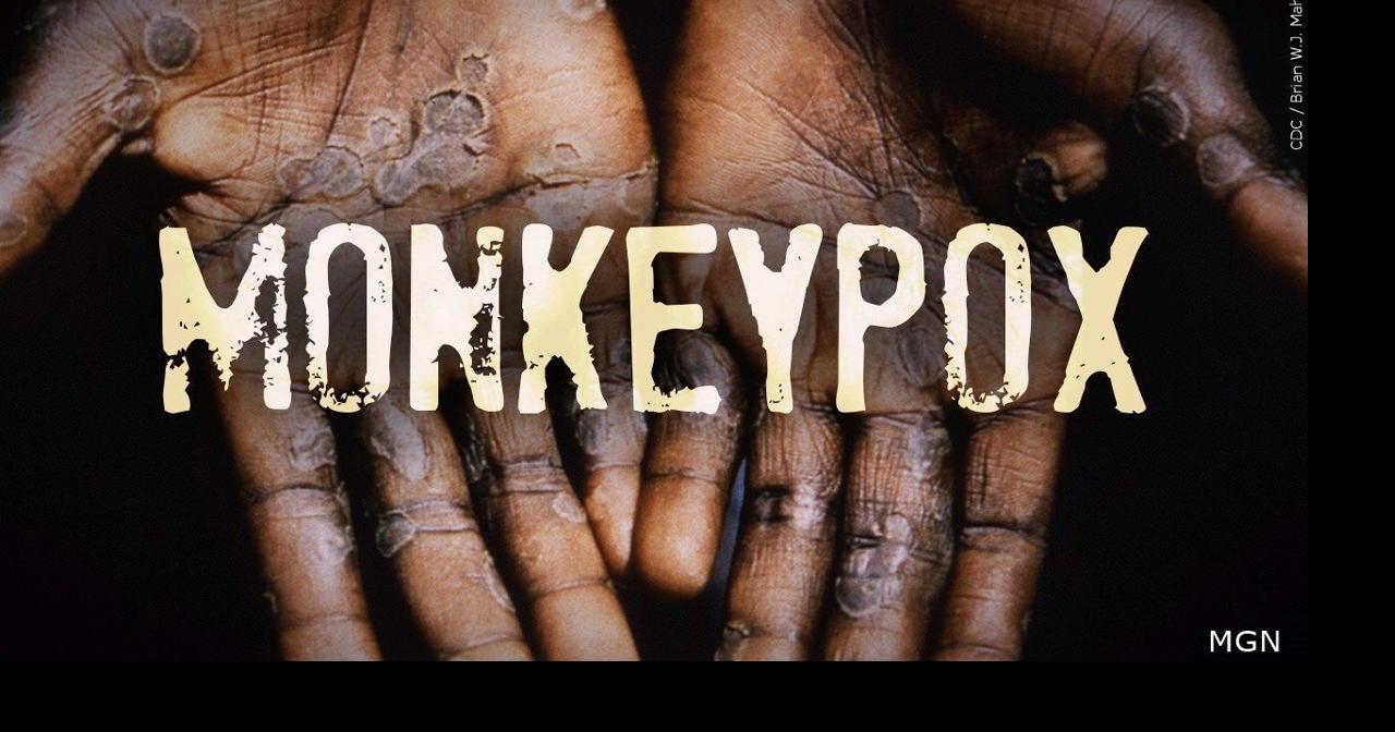 Reading Hospital doctor doesn't see monkeypox pandemic | Health | wfmz.com