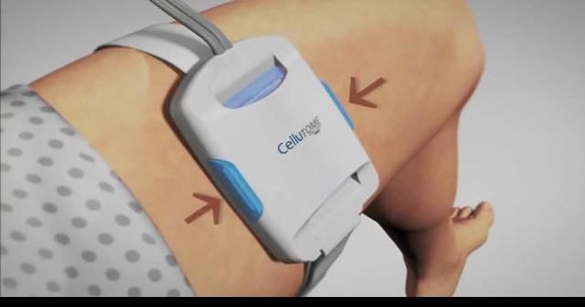 Cellutome procedure helps heal open wounds without painful surgery ...