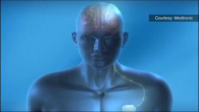 Life Lessons: Brain pacemaker for Alzheimer's | 69News at Sunrise ...
