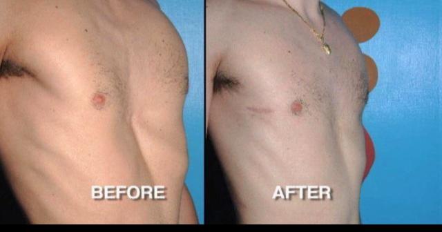 Health Beat: Concave chest in teens | Health | wfmz.com