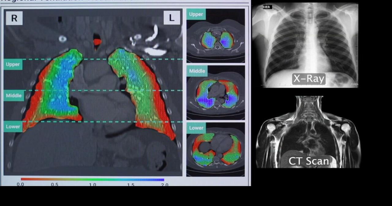 Health Beat: World’s first 4D scan of long COVID lungs | Health Beat ...