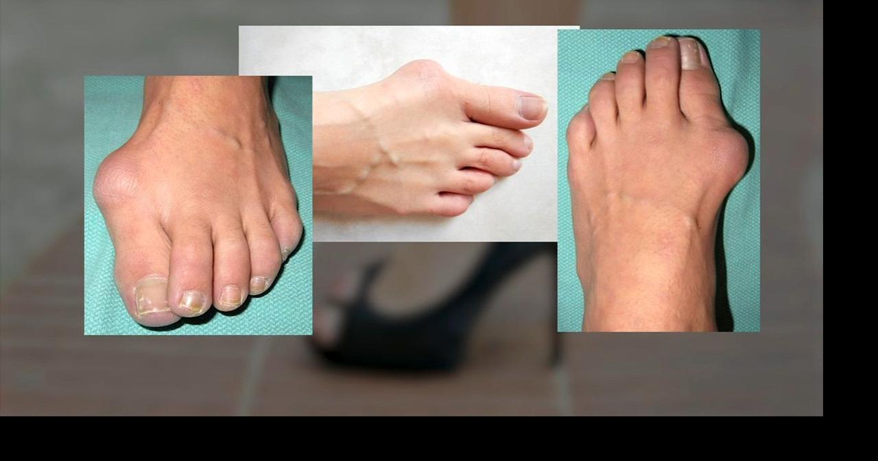 Health Beat: Bunion buster | Health Beat | wfmz.com