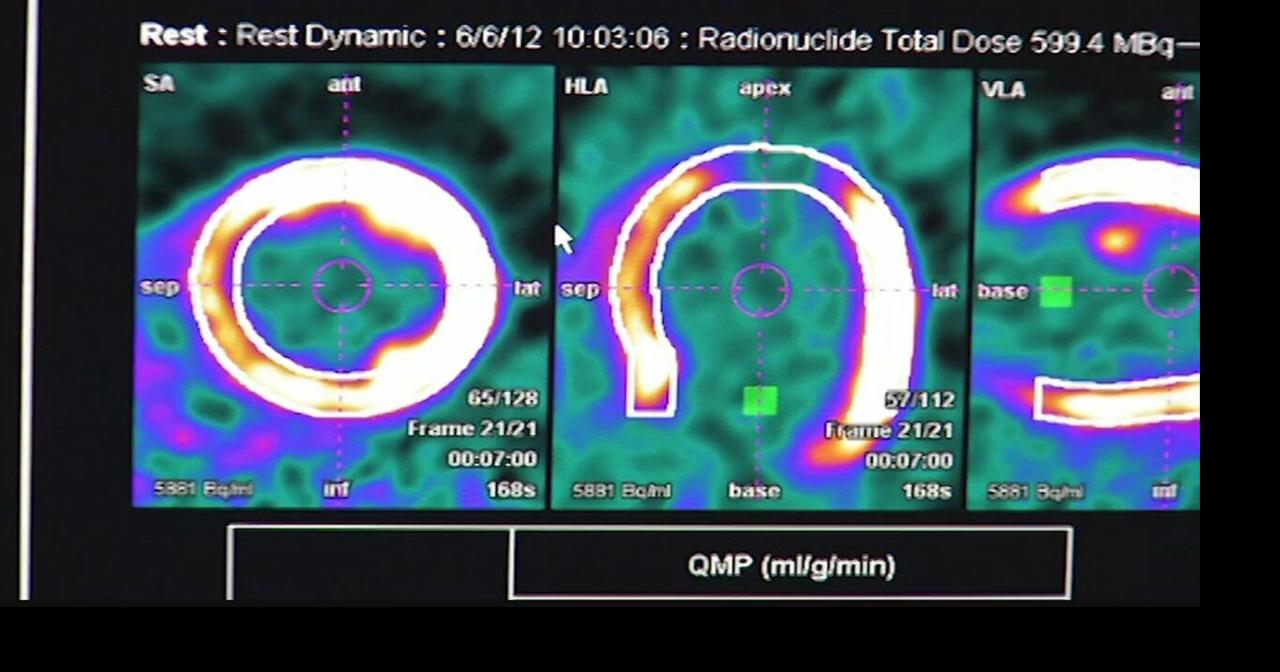 Health Beat: Aeson Total Heart, experimental pump for patients with ...
