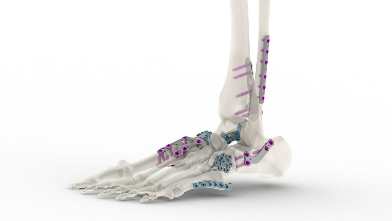 Tyber Medical, maker of orthopedic devices, gets clearance for Canadian ...