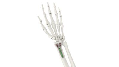 Tyber Medical gains FDA approval for additional products for its 'Mini ...