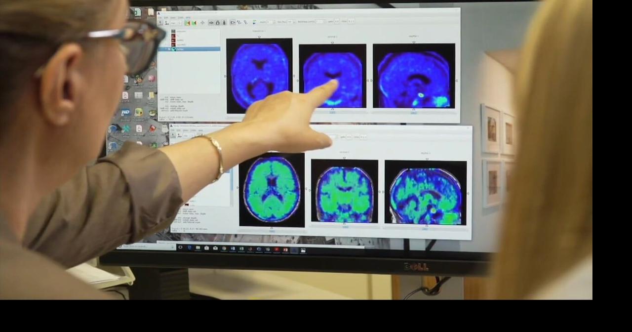 Health Beat: Exploring the link between PCOS and cognitive decline ...