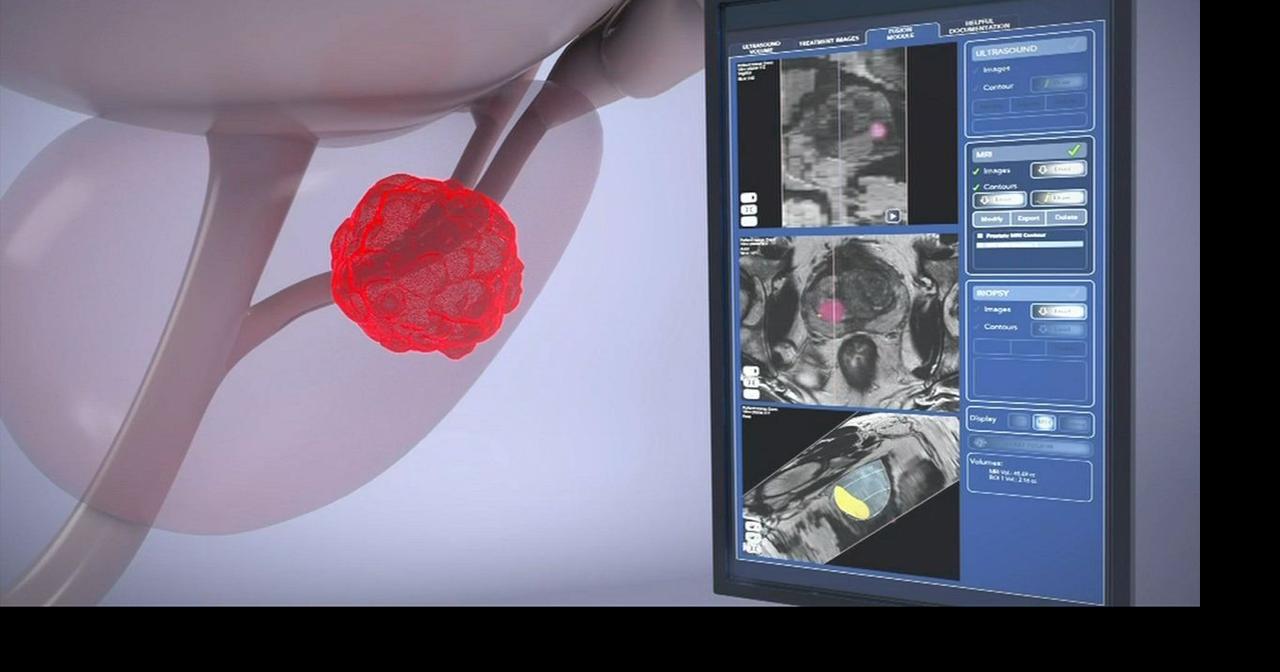 Health Beat: Prostate cancer: Who are best candidates for HIFU ...