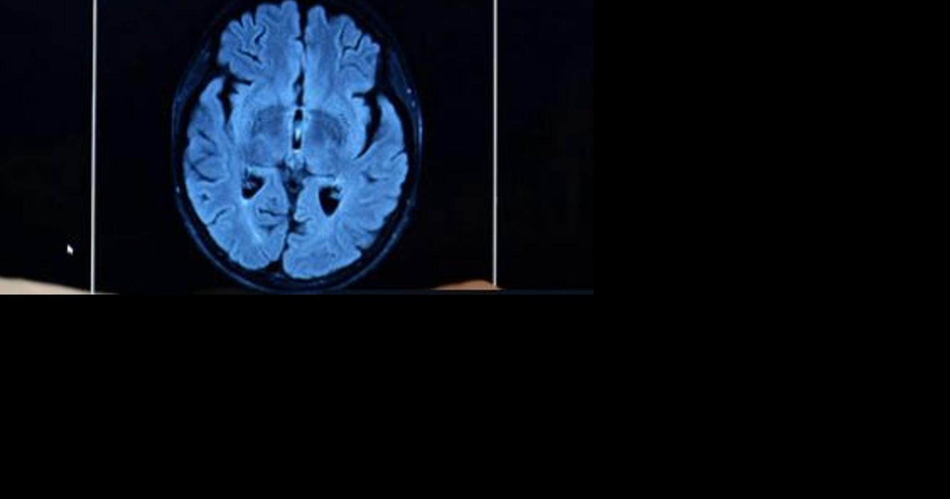 Health Beat: Increasing dementia risk | Health Beat | wfmz.com