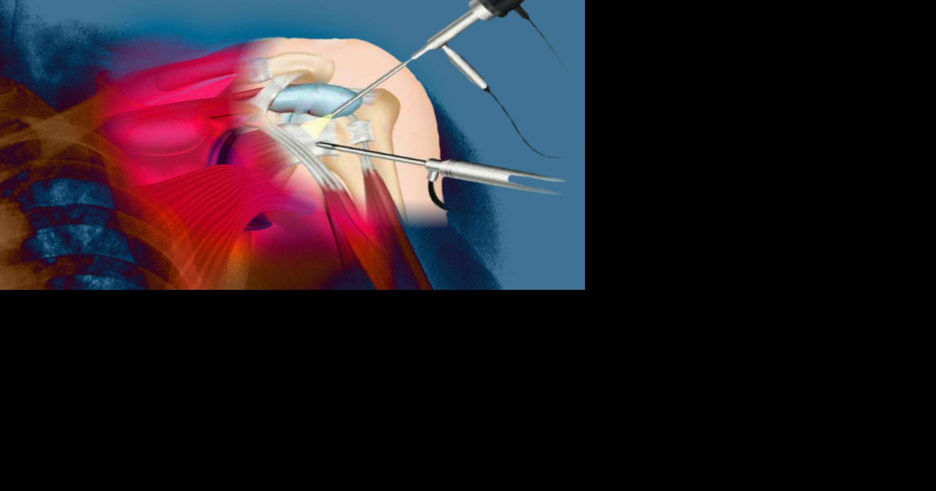 Health Beat: Fixing frozen shoulder syndrome | Health | wfmz.com