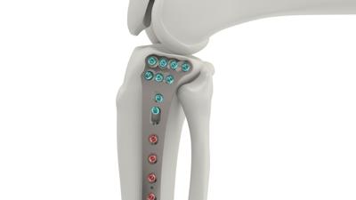 Tyber Medical gets FDA approval for system that helps heal leg bones ...