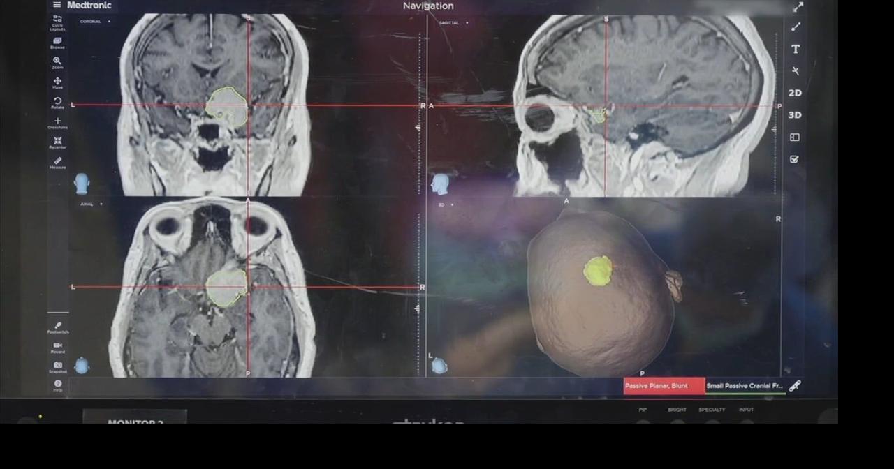 Health Beat: AVM: A silent killer of young people | | wfmz.com