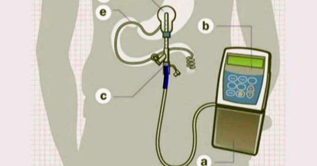 Health Beat: DUOPA for Parkinson's patients | Health | wfmz.com