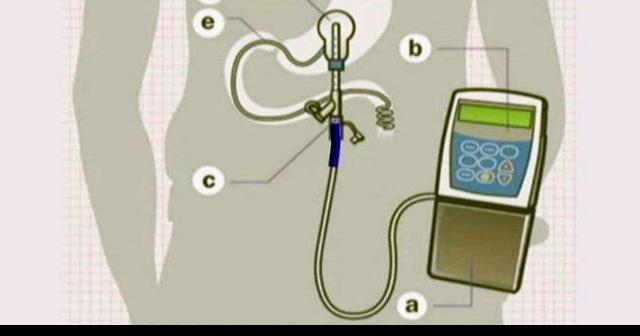 Health Beat: DUOPA for Parkinson's patients | Health | wfmz.com