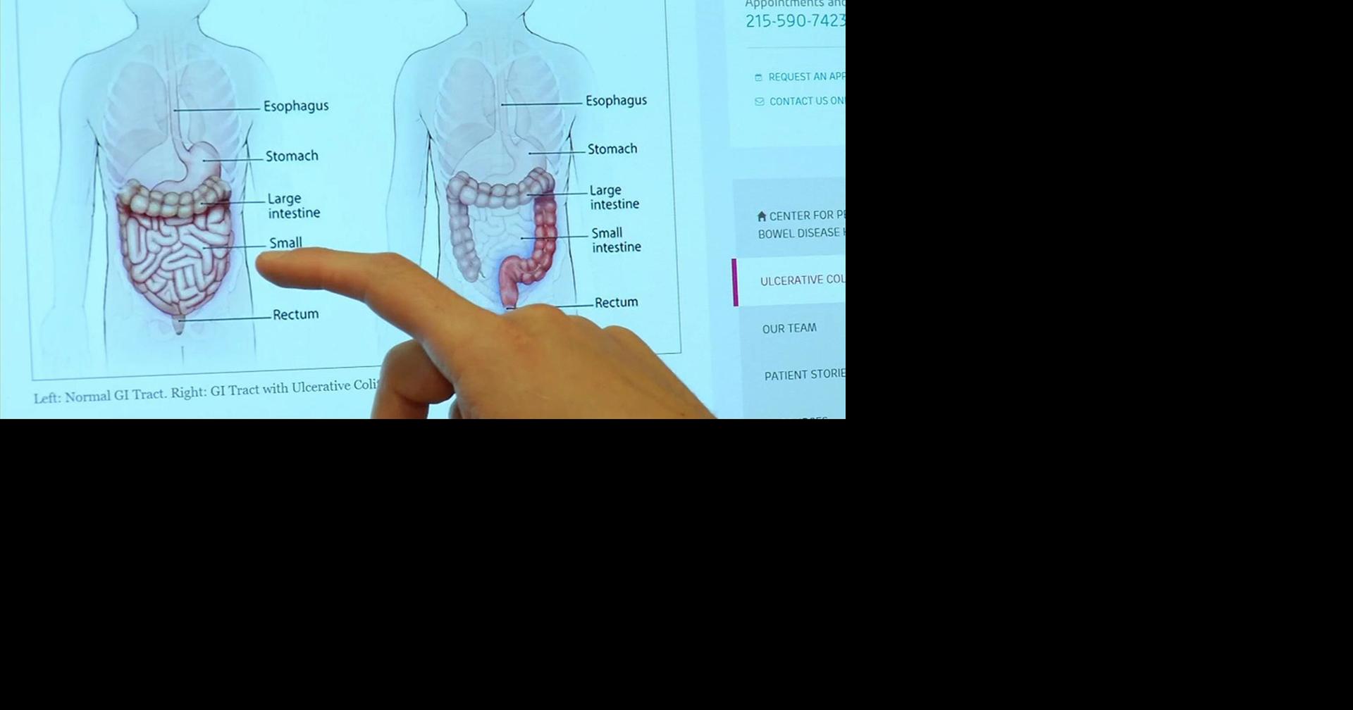 Health Beat: New discovery to calm IBD | Health Beat | wfmz.com