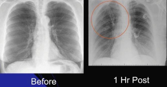 Health Beat: Breathing easier — emphysema coils | Health | wfmz.com